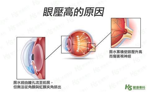 正常眼壓標準是多少眼壓過高5大症狀與原因又該如何降低眼壓 健康專科