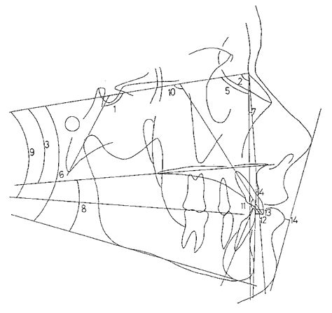 cephalometric tracing illustrating 11 angular and 3 linear download scientific diagram