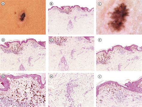 A C Clinical And Dermatoscopic Picture Of A Brown Papule On The