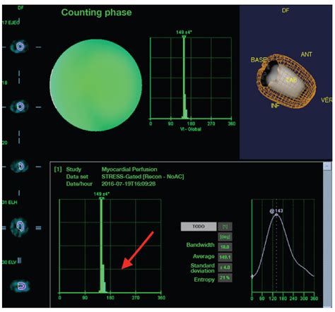 Phase Analysis For The Assessment Of Left Ventricular Dyssynchrony By