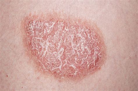 Symptoms Of Plaque Psoriasis