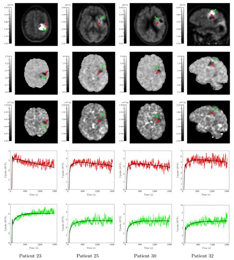 cancers free full text voxelwise principal component analysis of dynamic [s methyl 11c