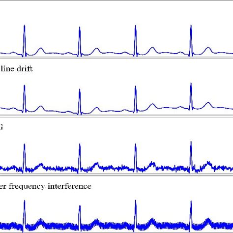 pdf ecg denoising method based on an improved vmd algorithm