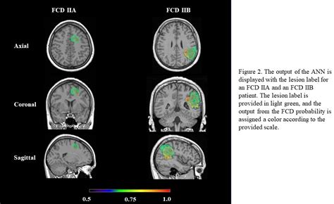 external evaluation of an artificial neural network for automated detection of type ii focal