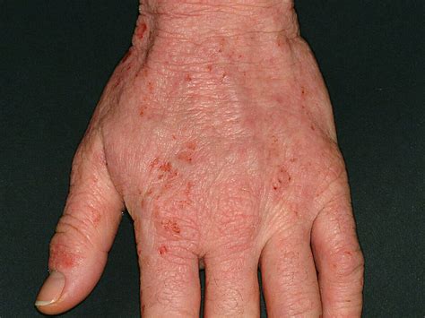 Atopic Dermatitis On Hands