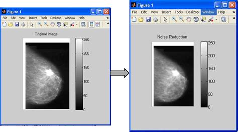 figure 5 from development algorithm computer program of digital mammograms segmentation for