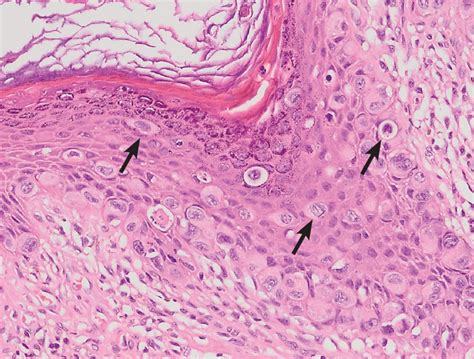 A Brownish Erythematous Patch In The Nipple Areola Complex Cleveland Clinic Journal Of Medicine