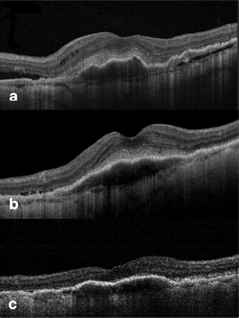 Case 3 Spectral Domain Optical Coherence Tomography SD OCT Image