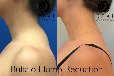 Buffalo Humps Are More Common Than Most People Think This Patient Is