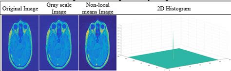 figure 1 from brain tumor detection based on multilevel 2d histogram image segmentation using