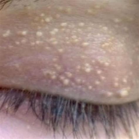 White Bump On Eyelid Eyelid Bumps 101 How To Identify Styes Milia Pimples Allure When This