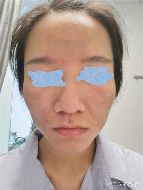 第一次做点阵激光去痘坑 知乎