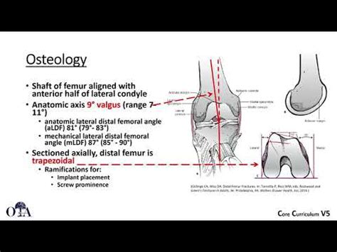 Distal Femur Fractures OrthoClips