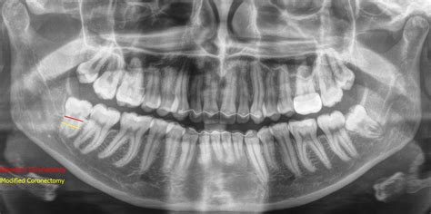 how cbct is becoming an essential tool in decision making