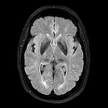 Normal MRI Brain Adult Image Radiopaedia Org