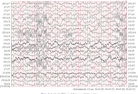 figure 1 from automatic epileptic seizure detection based on eeg signals using deep learning