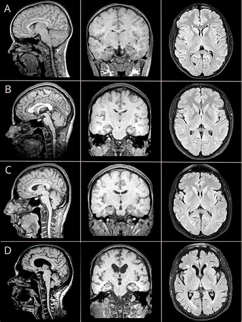 Frontiers Brain Morphometry And Cognitive Performance In Normal Brain