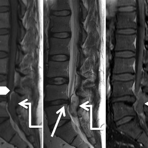 Pdf Imaging In Spinal Posterior Epidural Space Lesions Free Nude Porn Photos