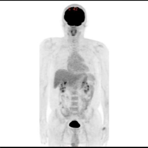 postoperative follow up positron emission tomographycomputed tomography download scientific