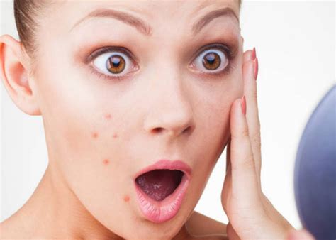 How To Remove Pimples Naturally And Permanently In One Day At Home In 2023