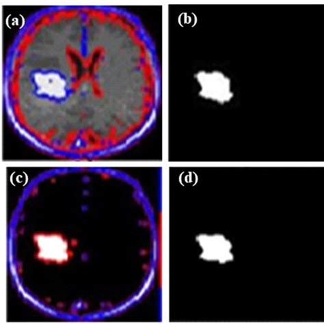 pdf cnn fusion based brain tumor detection from mri images using active contour segmentation