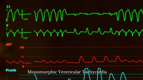 Monomorphic Vs Polymorphic Ventricular Tachycardia