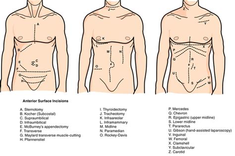 Rocky Davis Incision