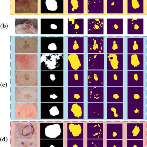 different networks performance on tricky skin lesion segmentation download scientific diagram
