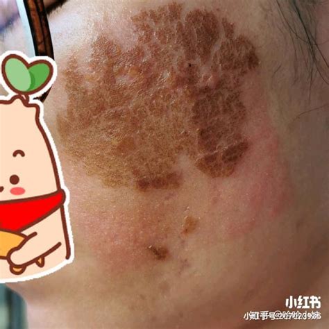 第一次做点阵激光去痘坑 知乎