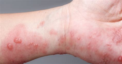 5 Common Skin Rash Types And Their Symptoms Marham