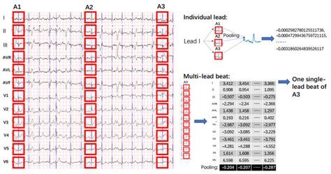 automatic arrhythmia detection with multi lead ecg signals based on heterogeneous graph