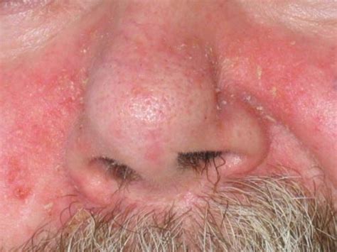 Derm Dx A Rash On The Nasolabial Folds Eyelashes And Scalp Clinical Advisor